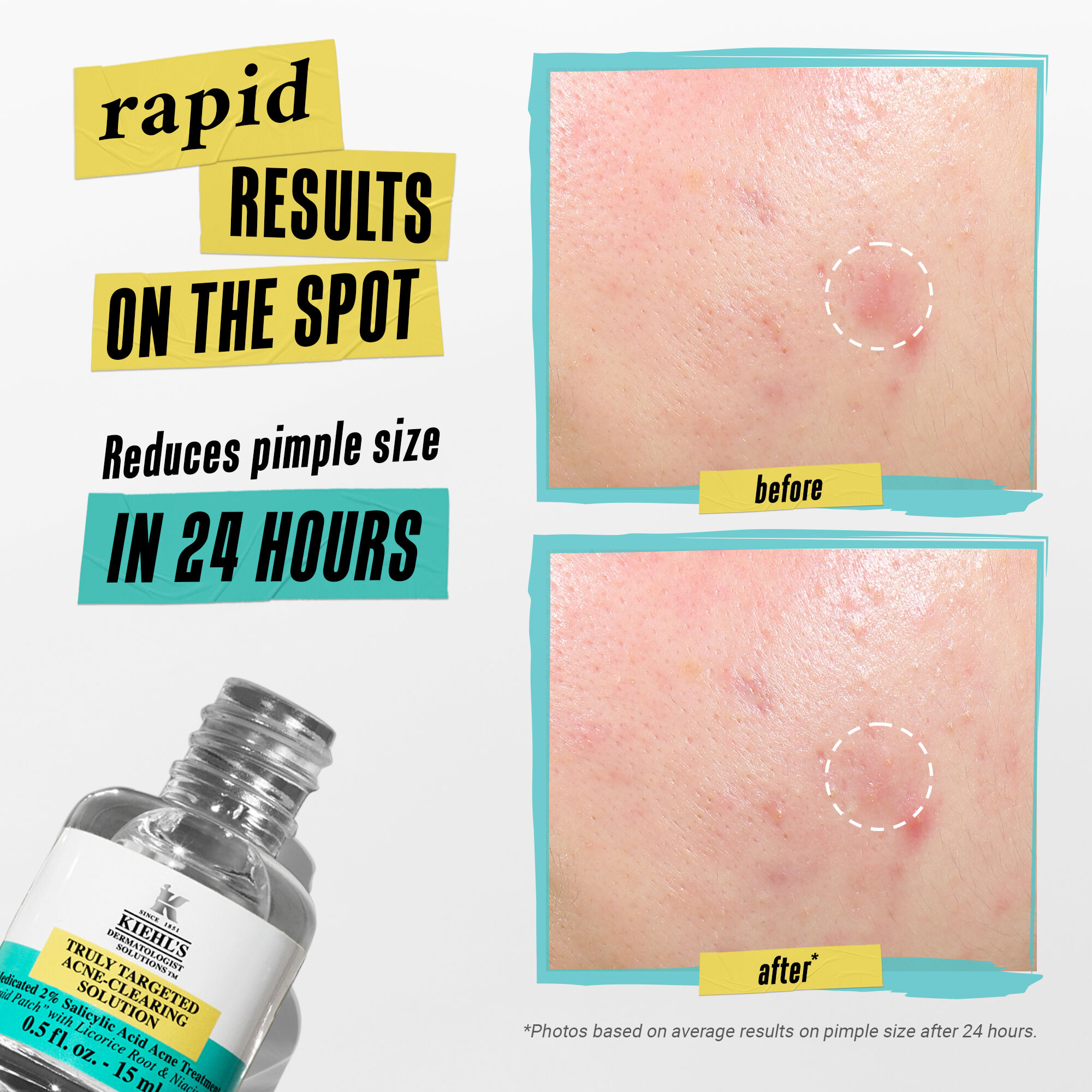 Truly Targeted Acne-Clearing Solution — Pimple Patch — Kiehl’s CA