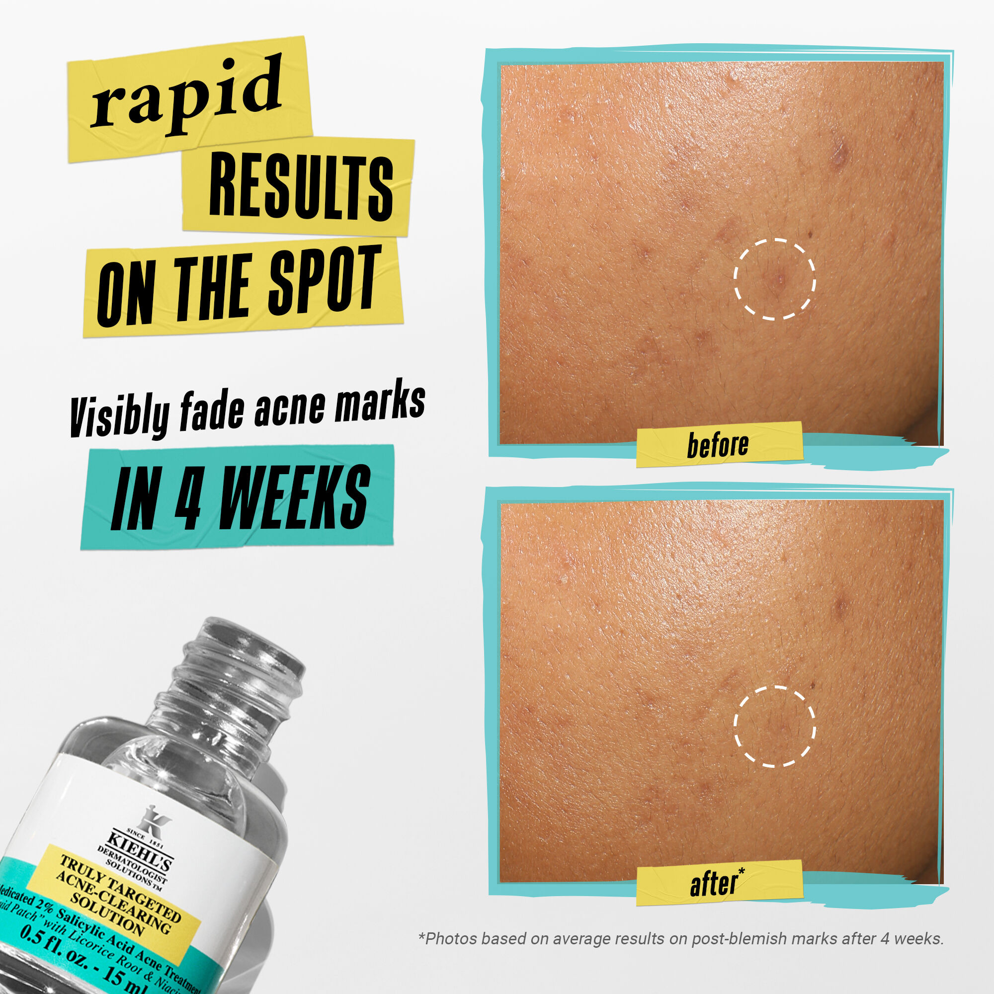 Truly Targeted Acne-Clearing Solution — Pimple Patch — Kiehl’s CA